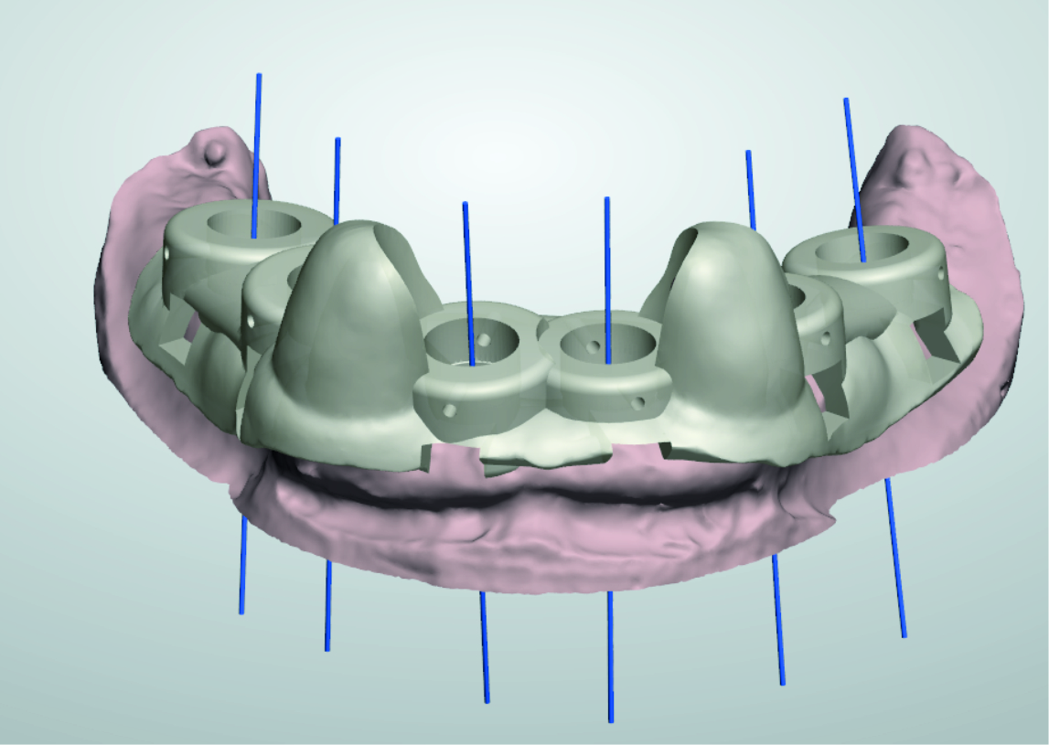 Cirugía guiada en implantes dentales
